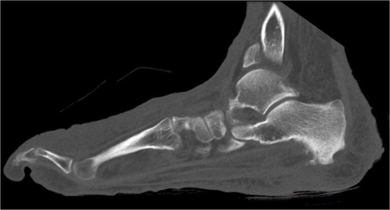 Foot and Ankle CT Scan - Advanced 3D Imaging